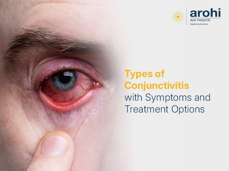 conjunctivitis treatment