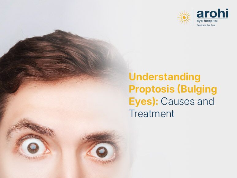 Understanding Proptosis (Bulging Eyes): Causes and Treatment